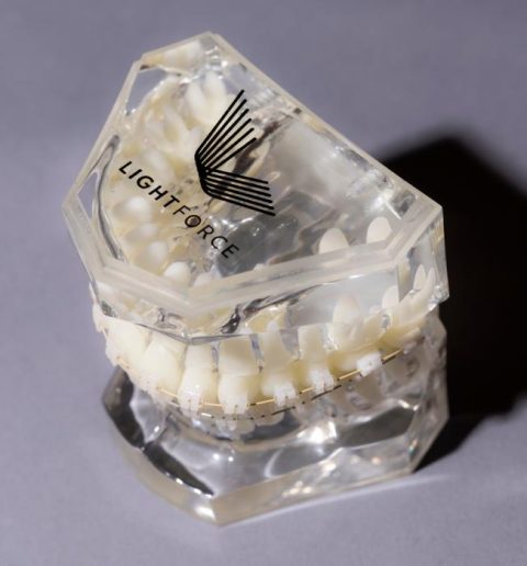 Lightforce Brackets Edmonton, AB | Towne Square Orthodontics